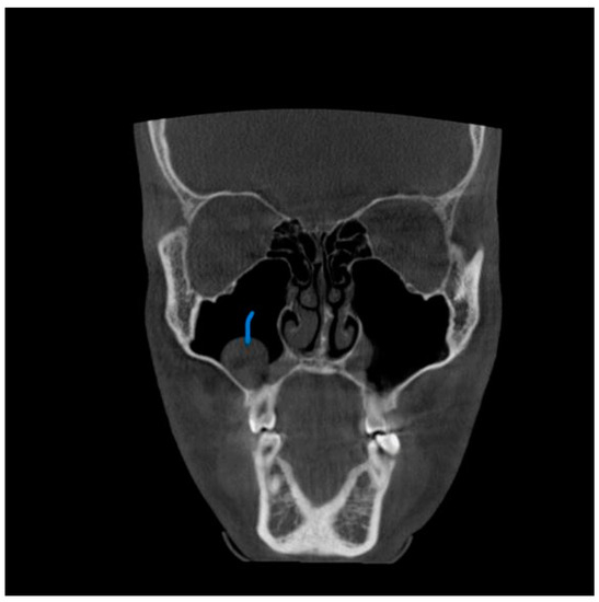 Prevalence of Incidental Maxillary Sinus Anomalies on CBCT Scans: A Radiographic Study