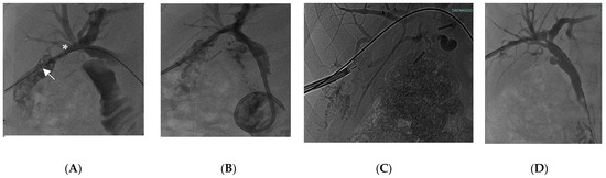 The Role of Cholangioscopy in Biliary Diseases
