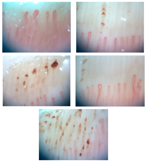 Reversible Cerebral Vasoconstriction Syndrome and Raynaud’s Phenomenon ...