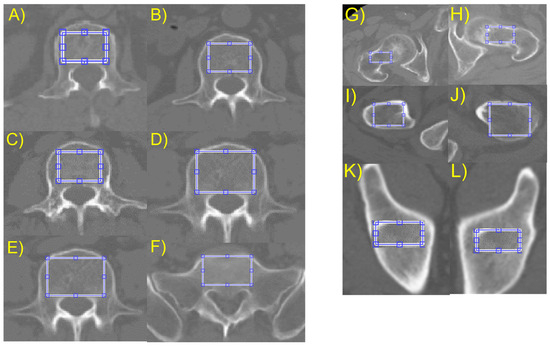 Assessing Bone Mineral Density in Weight-Bearing Regions of the Body ...