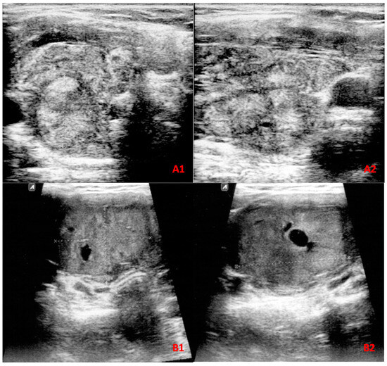 Diagnostic Performance of ACR TI-RADS and ATA Guidelines in the ...