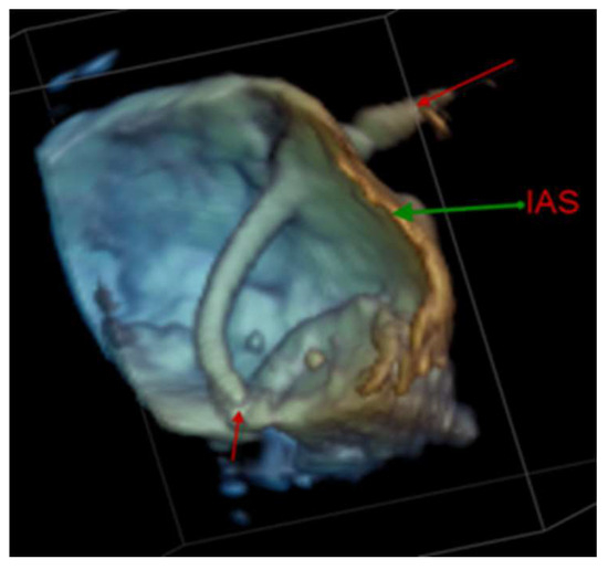 Advances in TEE-Centric Intraprocedural Multimodal Image Guidance for ...