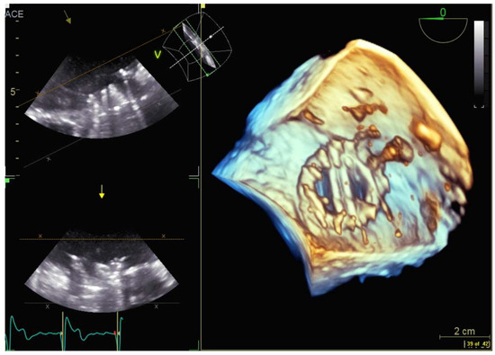 Advances in TEE-Centric Intraprocedural Multimodal Image Guidance for ...