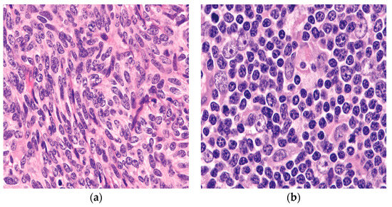 Thymoma: An Overview