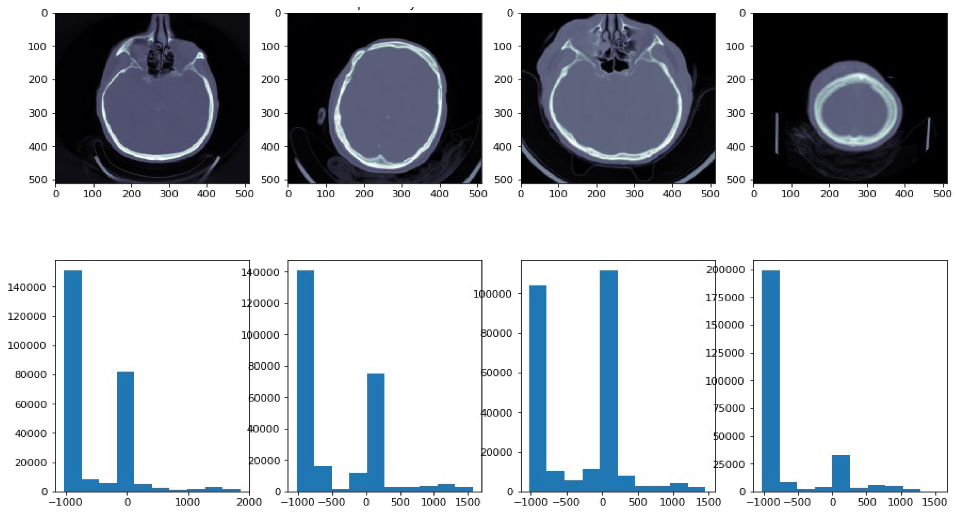 Automated Computer-Aided Detection and Classification of Intracranial Hemorrhage Using Ensemble ...