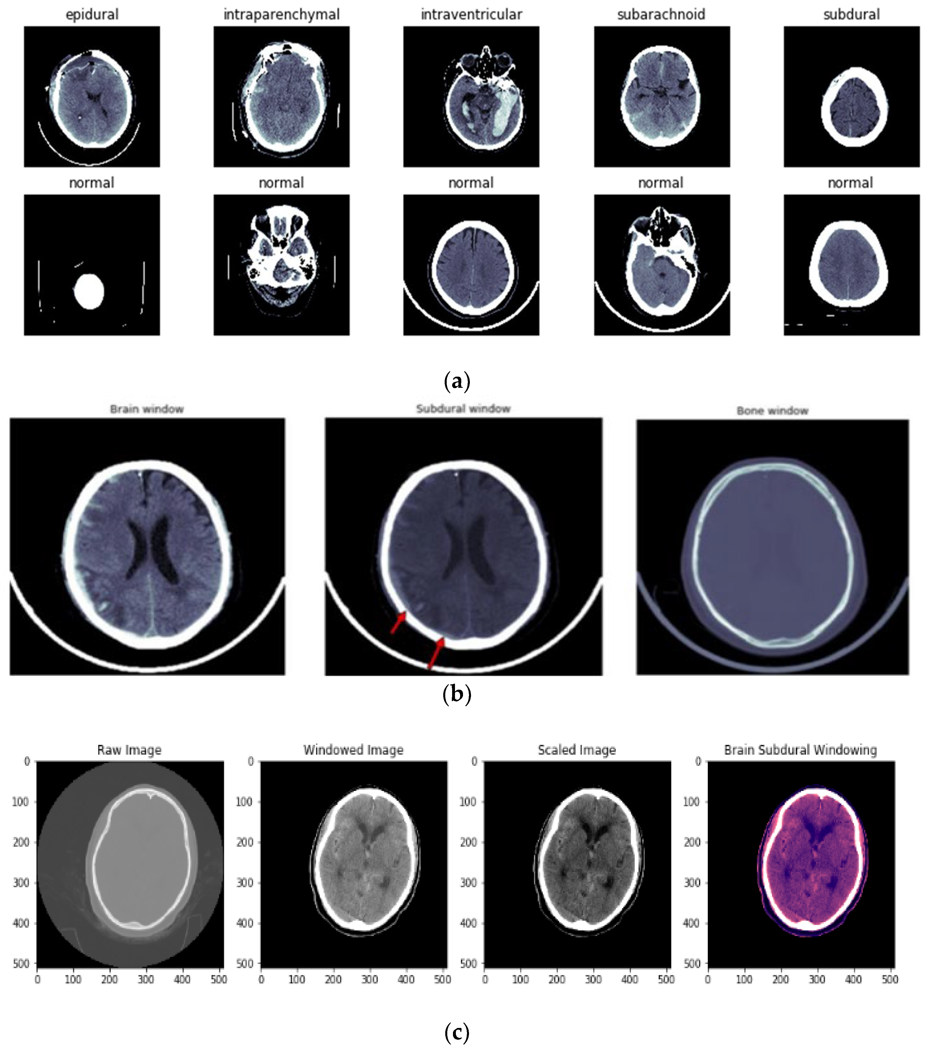 Automated Computer-Aided Detection and Classification of Intracranial ...