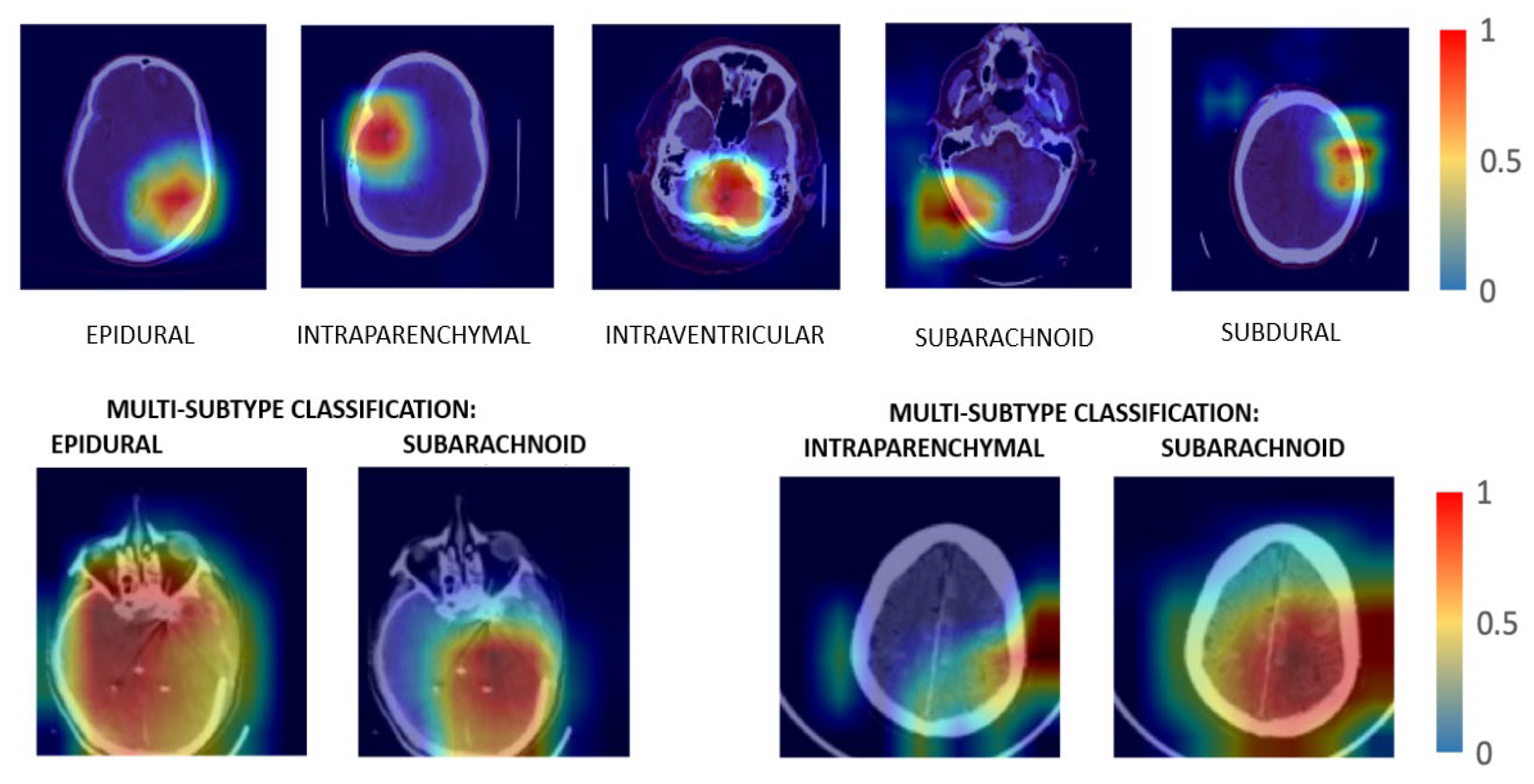 Automated Computer-Aided Detection and Classification of Intracranial Hemorrhage Using Ensemble ...