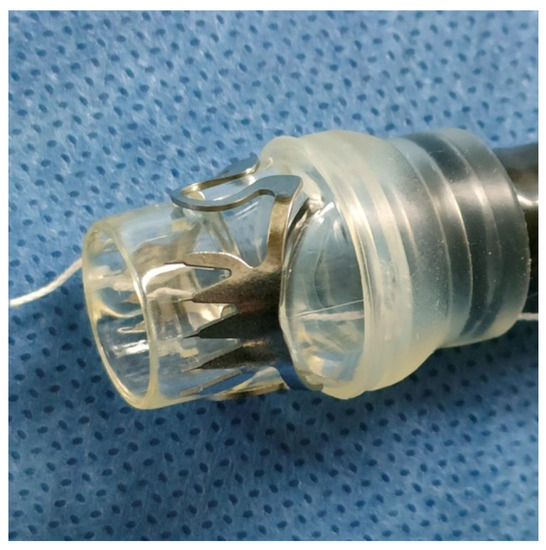 Outcomes of Endoscopic Intervention Using Over-the-Scope Clips for ...