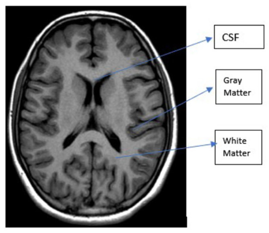 A Review of Recent Advances in Brain Tumor Diagnosis Based on AI-Based ...