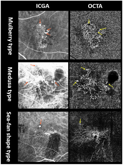 Factors Influencing Visual Acuity in Patients with Active Subfoveal ...