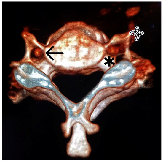 Double Transverse Foramina—An Anatomical Basis for Possible ...