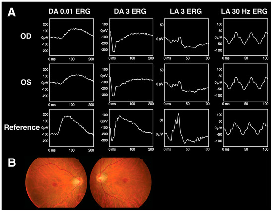 The Value of Electroretinography in Identifying Candidate Genes for ...