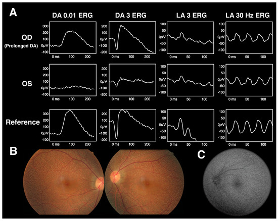 The Value of Electroretinography in Identifying Candidate Genes for ...