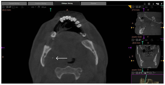 A Case of Broken Local Anesthetic Needle in the Pterygomandibular Space ...
