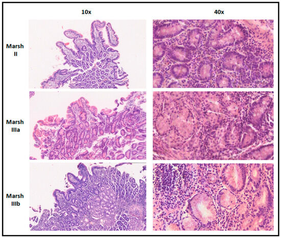 Diagnostics | Free Full-Text | Celiac Disease in Uzbek Children ...