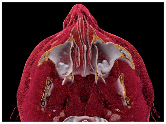 Diagnostics | Free Full-Text | Evaluation of Bilateral Maxillary Sinus ...