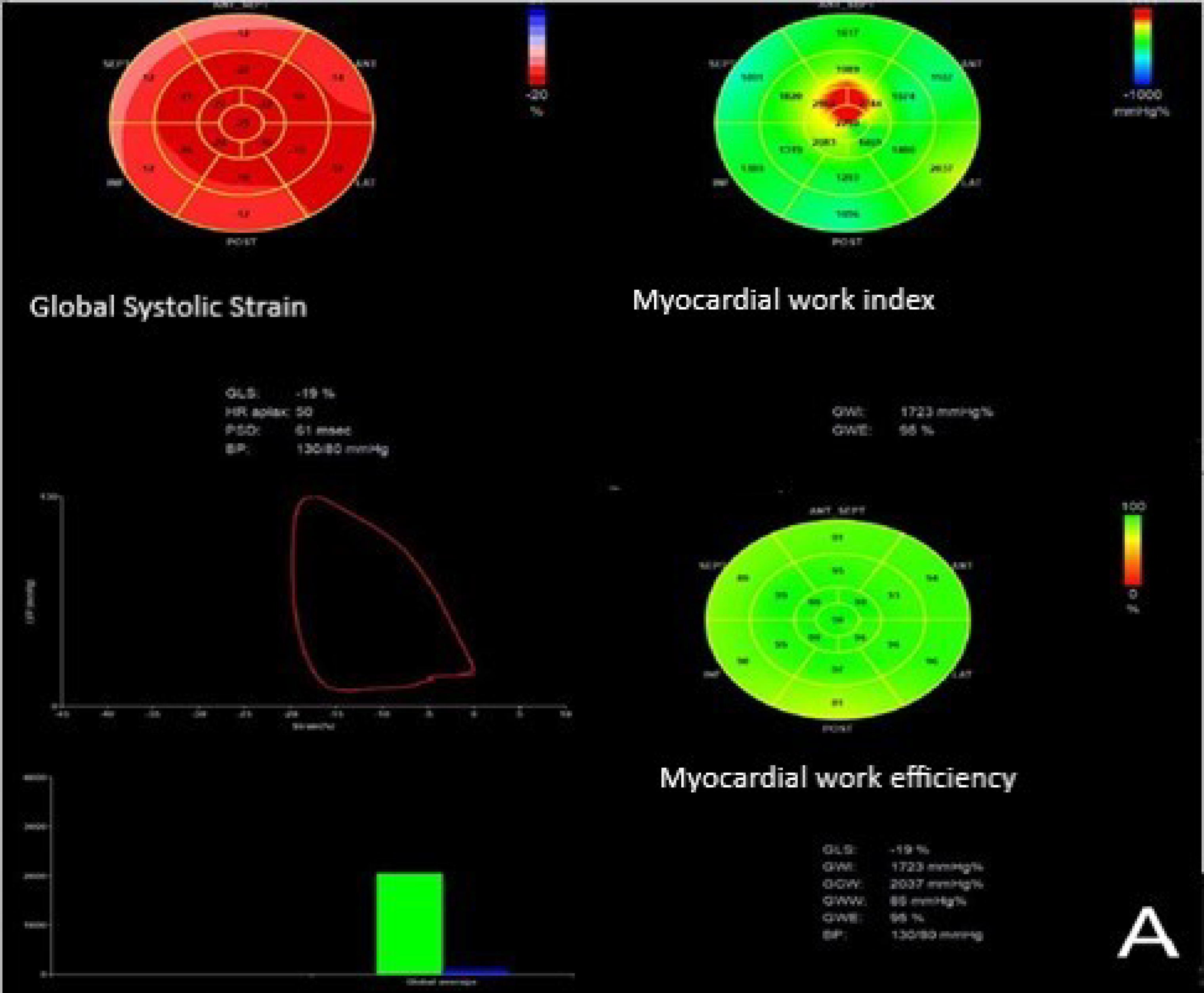 Subtle Changes in Myocardial Work Indices Assessed by 2D-Speckle ...