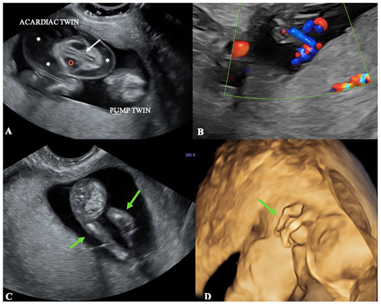 “The Strange Case of Dr Pump and Mr Acardiac”: The Twin Reversed ...