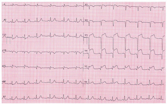 Acute Coronary Syndrome with Non-Obstructive Plaque on Angiography and ...