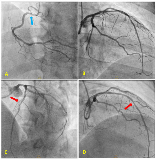 Acute Coronary Syndrome with Non-Obstructive Plaque on Angiography and ...