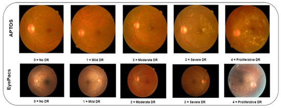 Diagnostics | Free Full-Text | A Lightweight Diabetic Retinopathy ...