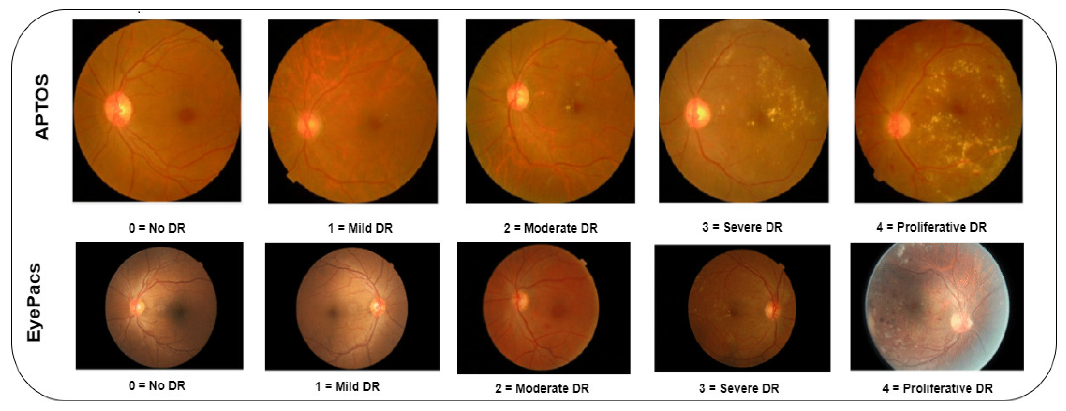 A Lightweight Diabetic Retinopathy Detection Model Using a Deep ... A Lightweight Diabetic Retinopathy Detection Model Using a Deep ...