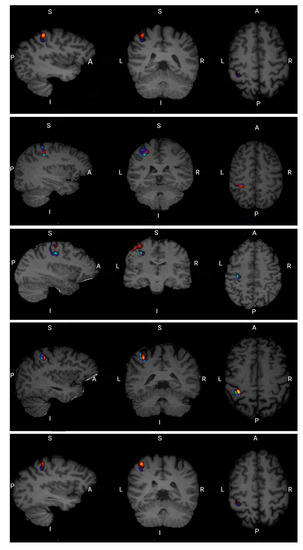 Functional FDG-PET: Measurement of Task Related Neural Activity in ...