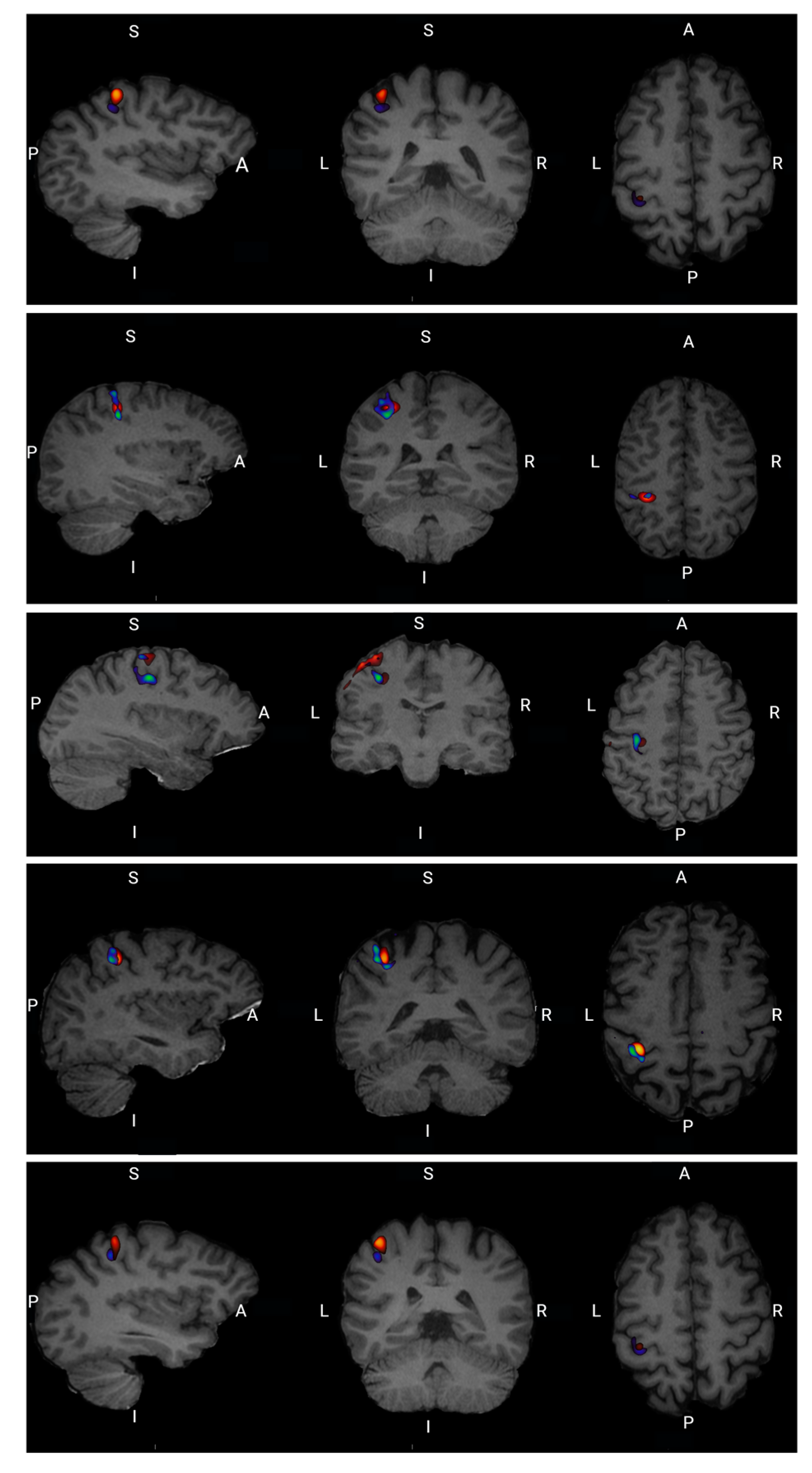 Functional FDG-PET: Measurement of Task Related Neural Activity in ...