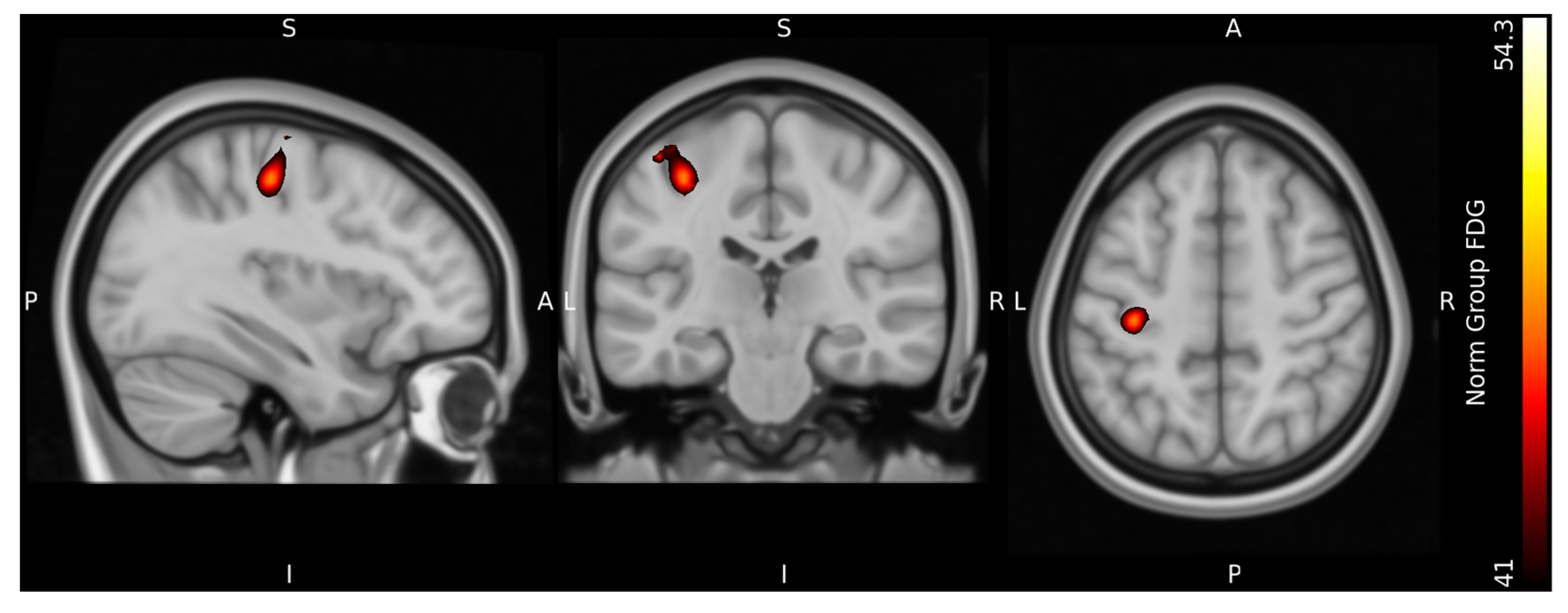 Functional FDG-PET: Measurement of Task Related Neural Activity in ...