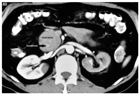 Endoscopic Ultrasound in Pancreatic Duct Anomalies