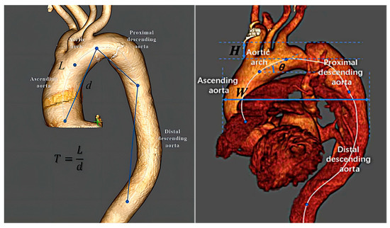 Establishing and Validating a Morphological Prediction Model Based on CTA to Evaluate the ...