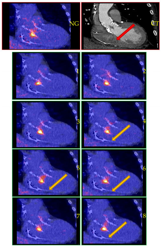 Improved [18F]FDG PET/CT Diagnostic Accuracy for Infective Endocarditis ...