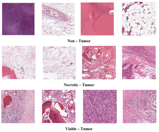 Adapted Deep Ensemble Learning-Based Voting Classifier for Osteosarcoma Cancer Classification