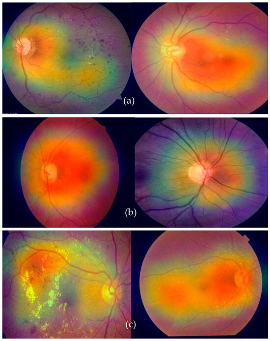 Deep-Ocular: Improved Transfer Learning Architecture Using Self-Attention and Dense Layers for ...