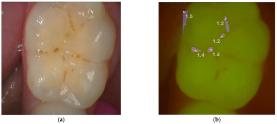 In Vivo Performance of Visual Criteria, Laser-Induced Fluorescence, and Light-Induced ...