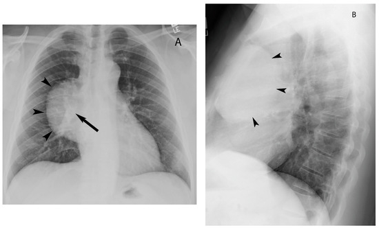 Diagnostics | Free Full-Text | Approach to Imaging of Mediastinal Masses