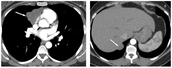 Diagnostics | Free Full-Text | Approach to Imaging of Mediastinal Masses