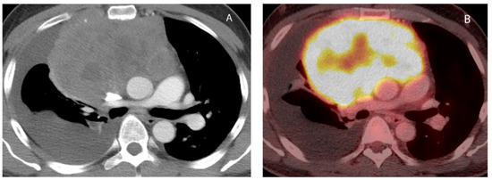 Diagnostics | Free Full-Text | Approach to Imaging of Mediastinal Masses