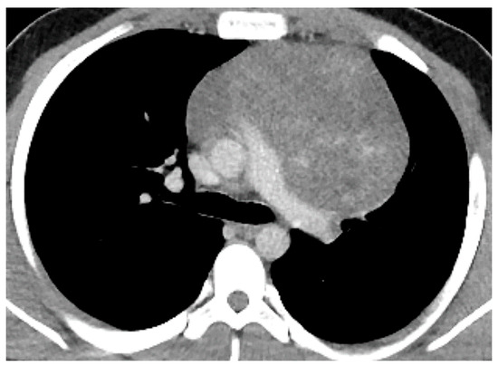 Diagnostics | Free Full-Text | Approach to Imaging of Mediastinal Masses