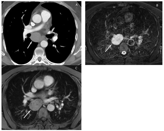 Diagnostics | Free Full-Text | Approach to Imaging of Mediastinal Masses