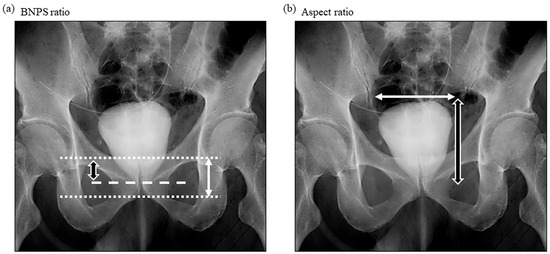 Postoperative Bladder Neck to Pubic Symphysis Ratio Predictive for De ...