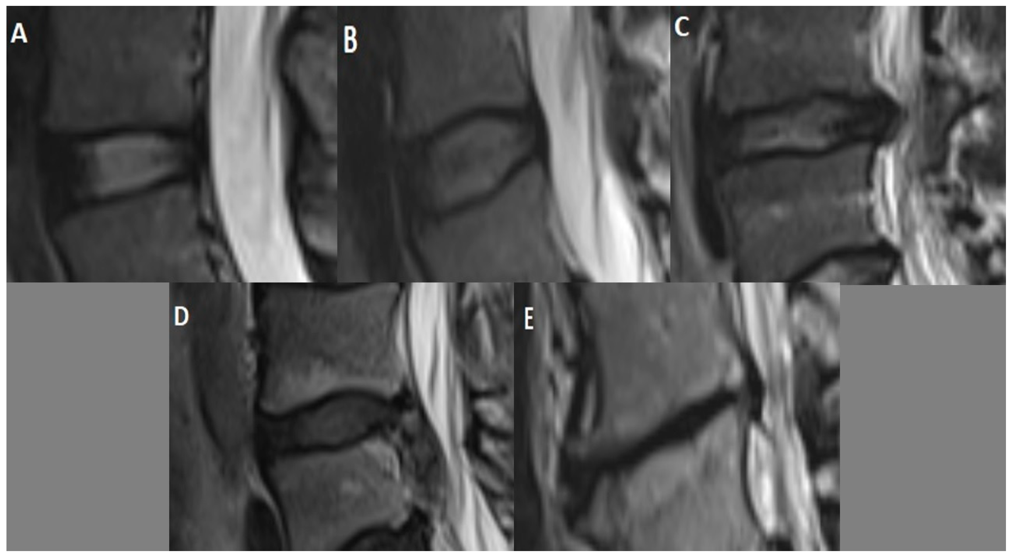 Intervertebral Disc Herniation Mri