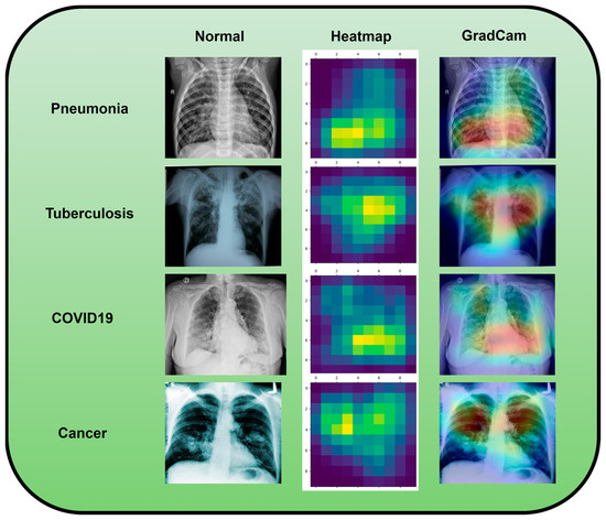 MixNet-LD: An Automated Classification System for Multiple Lung Diseases Using Modified MixNet Model