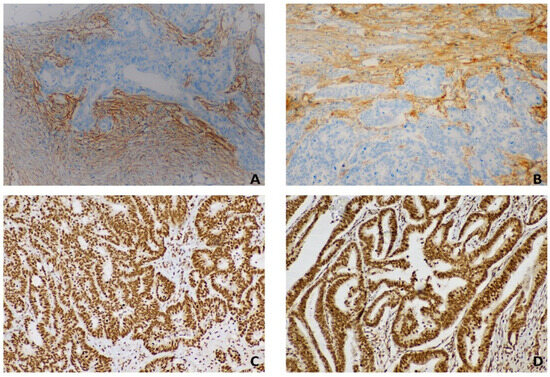 Tumor Progression from a Fibroblast Activation Protein Perspective ...