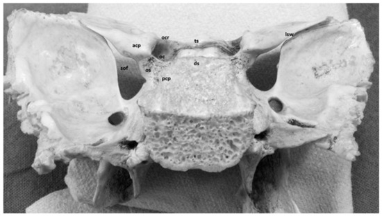 Petroclival Clinoidal Folds and Arachnoidal Membranes of the ...