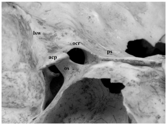 Petroclival Clinoidal Folds and Arachnoidal Membranes of the ...