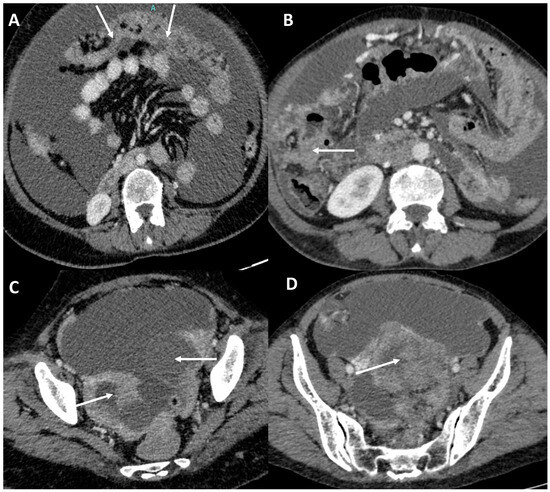 Clinical and Radiological Parameters to Discriminate Tuberculous ...