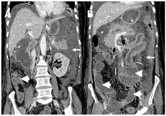Clinical and Radiological Parameters to Discriminate Tuberculous ...