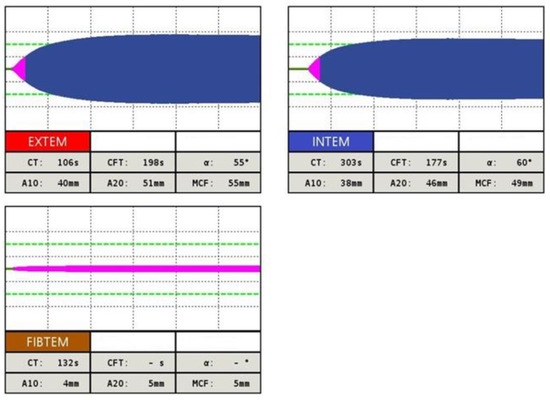 Basic Principles of Rotational Thromboelastometry (ROTEM®) and the Role ...