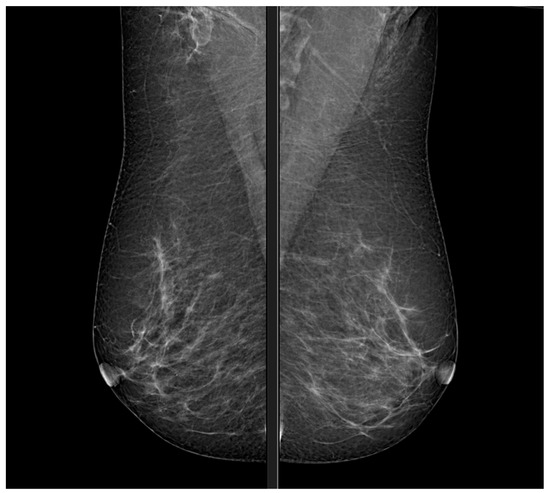 Breast Imaging Physics in Mammography (Part I)